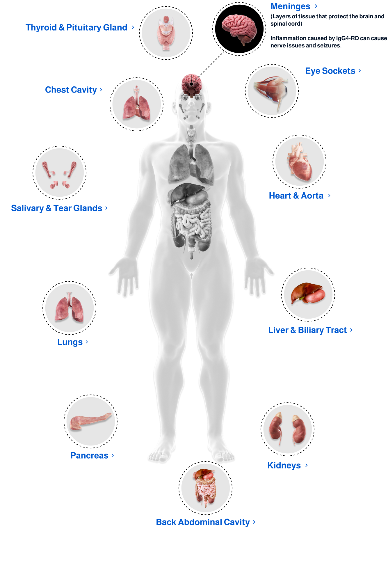 IgG4-RD Symptoms & Manifestations | UPLIZNA® (inebilizumab-cdon) for HCPs